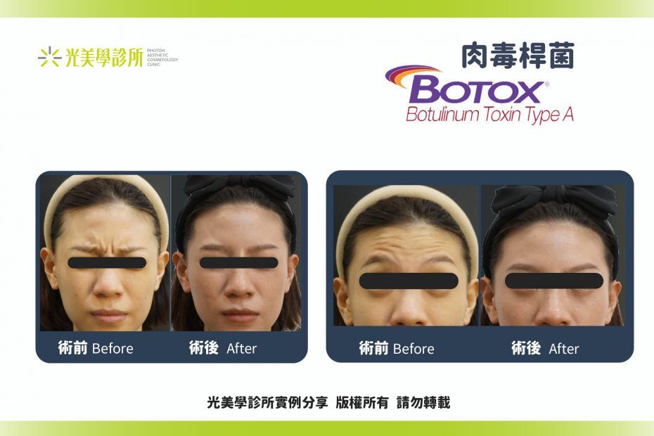 素人故事分享 - 屏東醫美｜光美學珍所｜蜂巢皮秒 ｜755蜂巢皮秒｜08-7381883